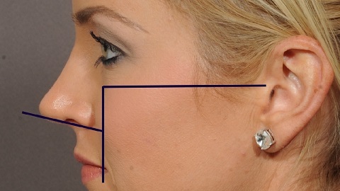 Effects of the Tongue-in-Groove Maneuver on Nasal Tip Rotation