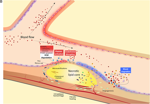 Atherosclerosis | European Heart Journal | Oxford Academic