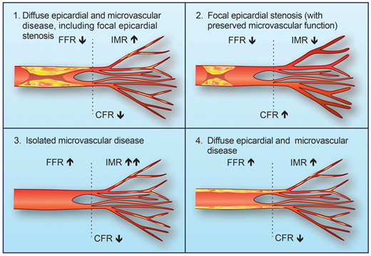 Acute Coronary Syndrome | European Heart Journal | Oxford Academic