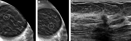Prediction Of Surgical Upstaging Risk Of Ductal Carcinoma In Situ Using